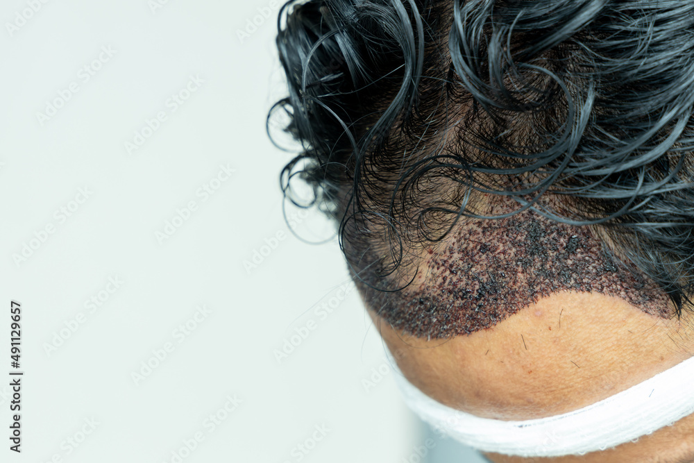 Man head with hair transplant surgery with receding hair line, FUE ...