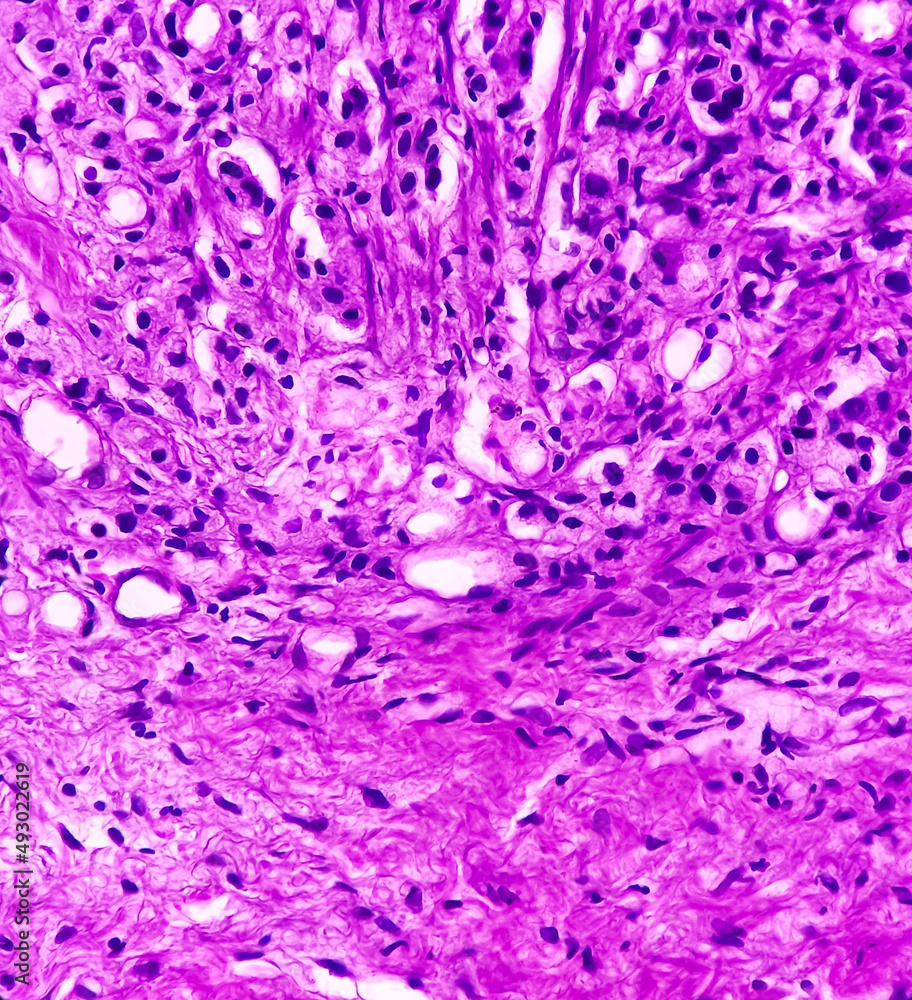 Prostate Cancer: Photomicrograph of biopsy of prostate gland showing ...