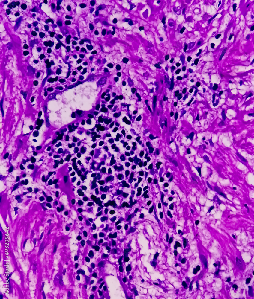 Prostate Cancer (TURP): Microscopic image of prostatic tissue ...