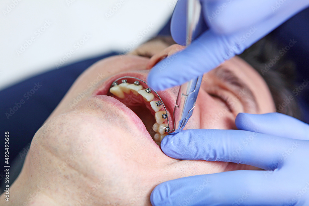 Foto de Stock Adjustment of braces during wearing. Braces on the teeth ...