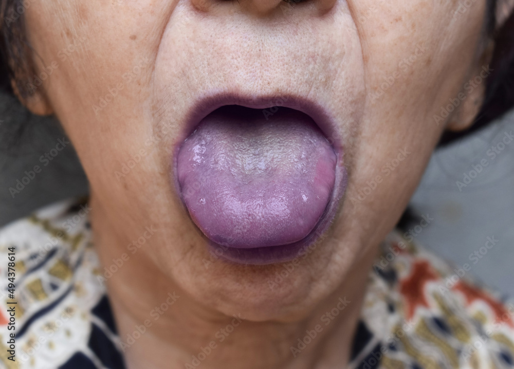 Cyanotic lips or central cyanosis at Asian, Chinese old woman Stock ...
