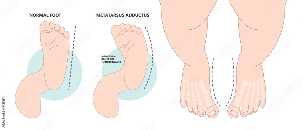 child knock knees Equinovarus W sit injury bow leg genu valgum varum ...