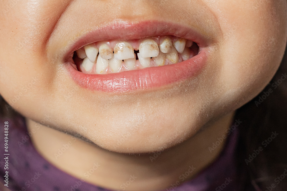 brown teeth child