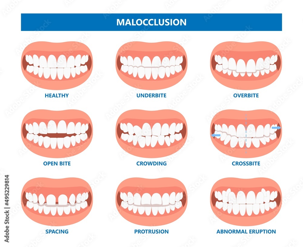 mouth open deep bad bite teeth gum Joint pain jaw surgery corrective ...