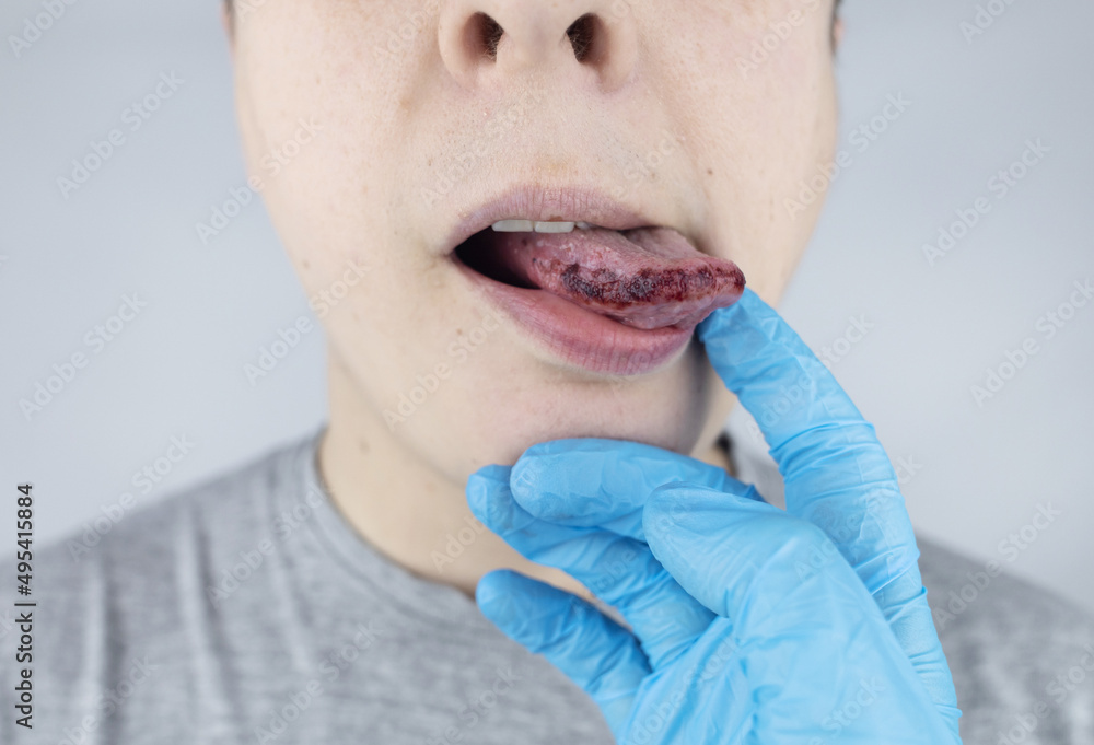 Black tongue. A man shows the consequences of an injury, bite or burn ...