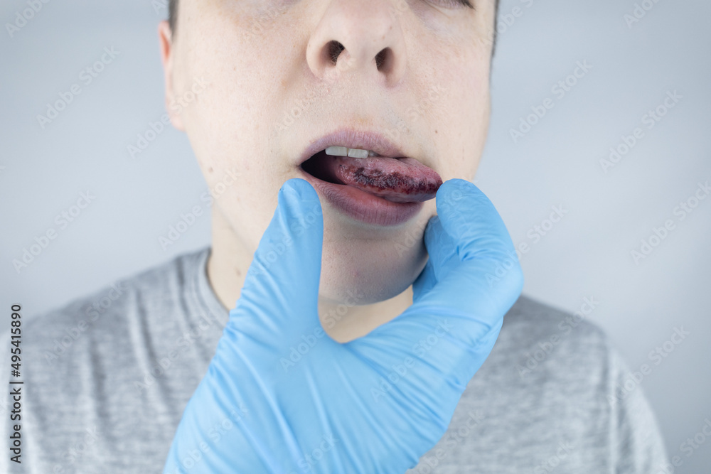 Black tongue. A man shows the consequences of an injury, bite or burn ...