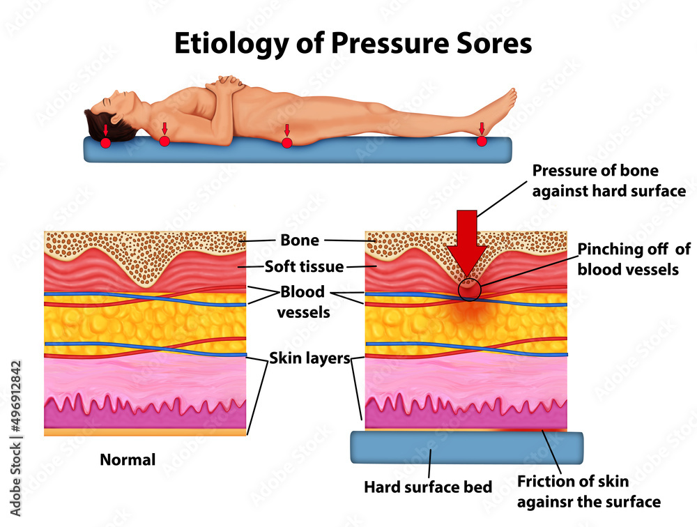 Etiology of pressure sores Stock Illustration | Adobe Stock