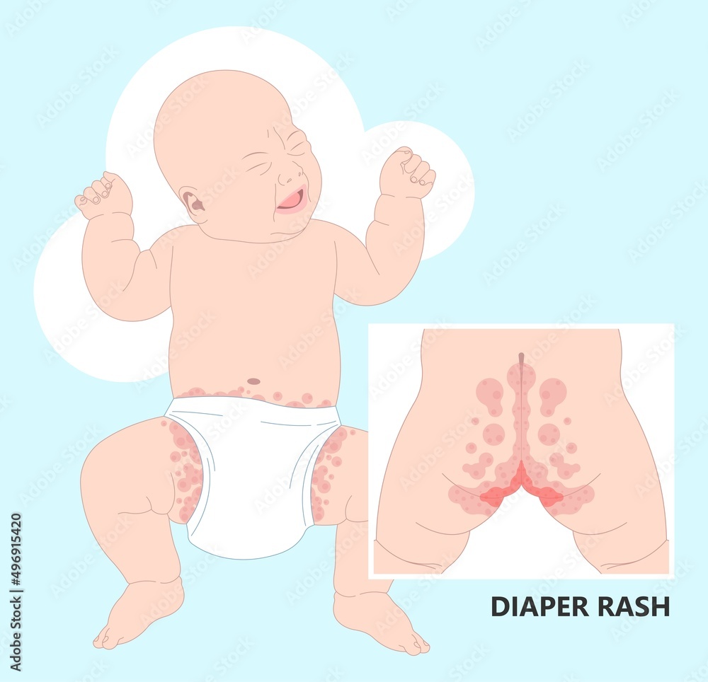 Vector de Stock baby Skin itchy rash allergy hives food cloth staph ...
