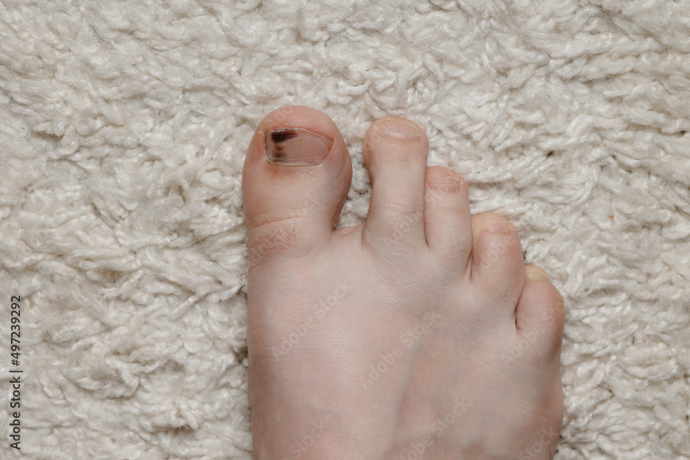 Stockfoto Subungual hematoma present under the toenail of the hallux ...