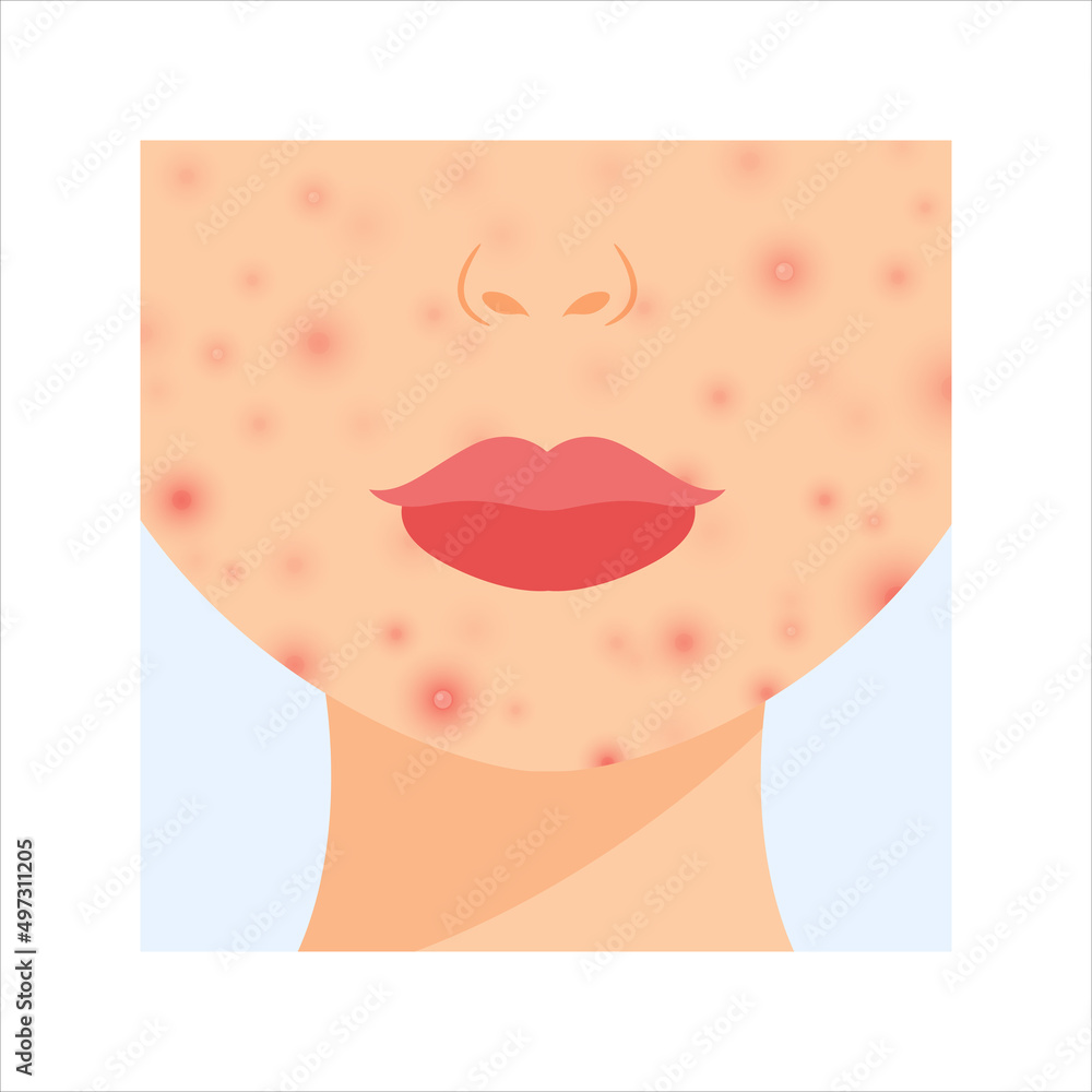 Problem Skin on Female Face. Acne. Pimples on Chin and Cheeks. Close up ...