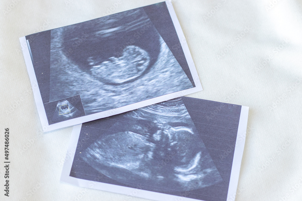 Photo Stock ultrasound pictures shows different gestational periods ...