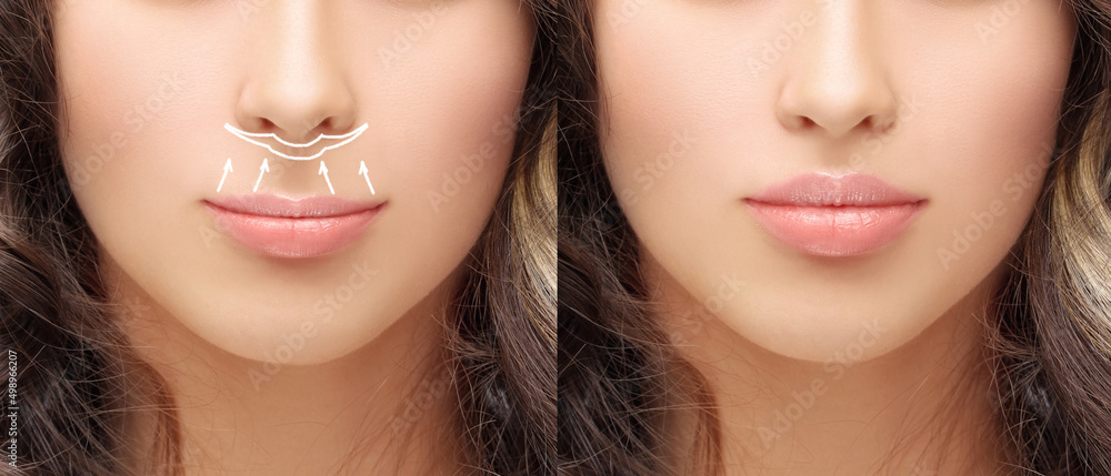 lip lift surgery,bullhorn technique, plastic surgery concept. Stock ...