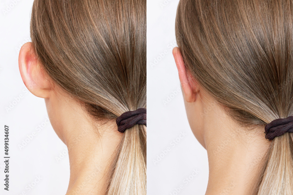 Cropped shot of woman's head with ears before and after otoplasty ...