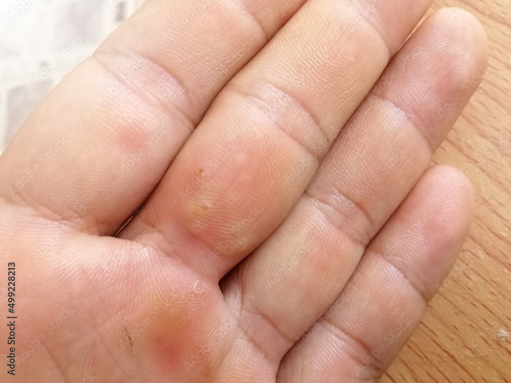 Eczema Blisters On Hands