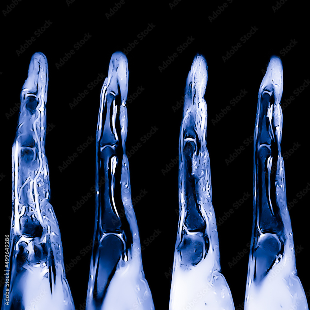 MRI X-ray image of a hand and fingers, with bones, muscle and tissue ...