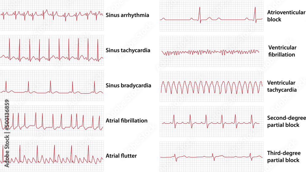 Schemes set of common electrocardiogram (ECG) abnormalities, including ...