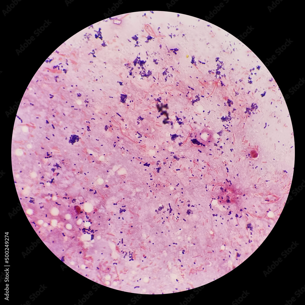 Cocci and bacilli bacteria in urine under 100X light microscope. Smear ...