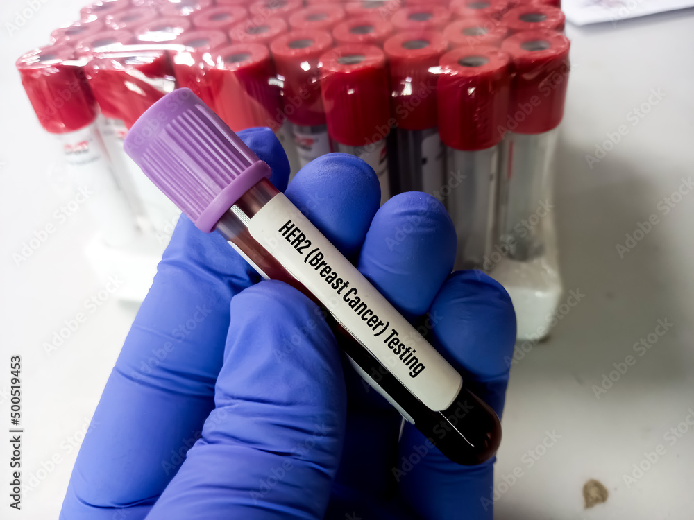 Blood sample for Her-2 breast cancer testing, human epidermal growth ...