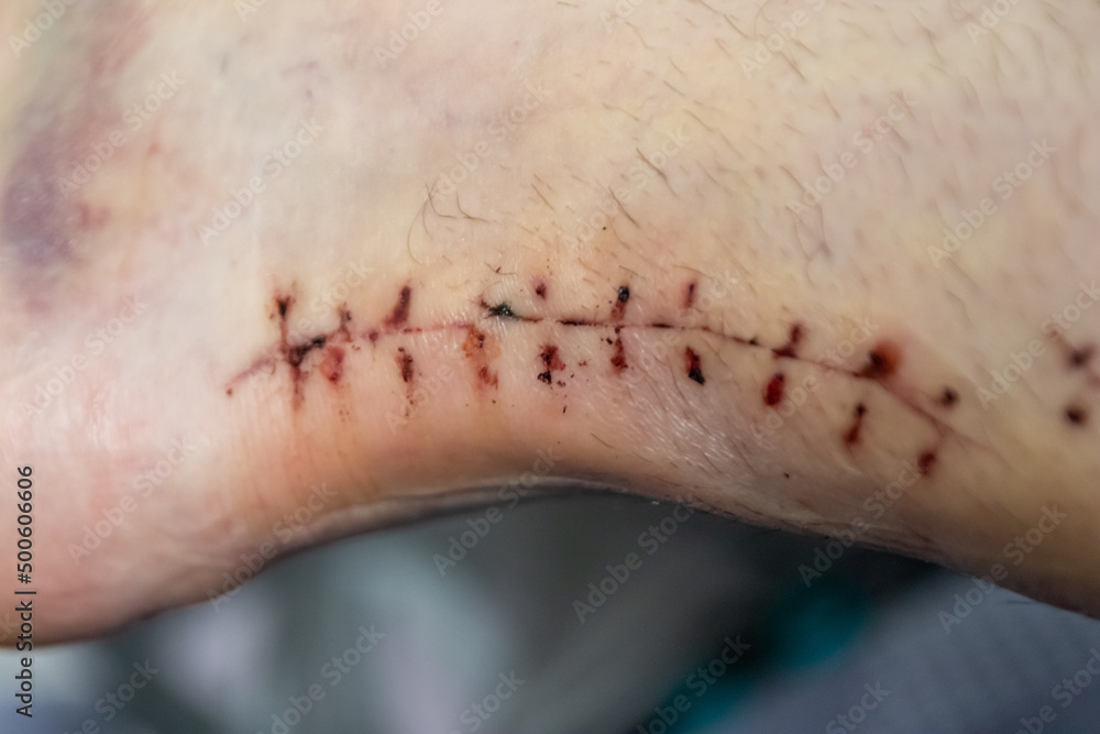 Wound suture after Achilles tendon rupture operation is treated and ...