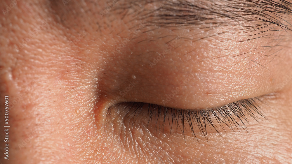 Wart skin removal. Macro shot of warts near eye on face. Papilloma on ...