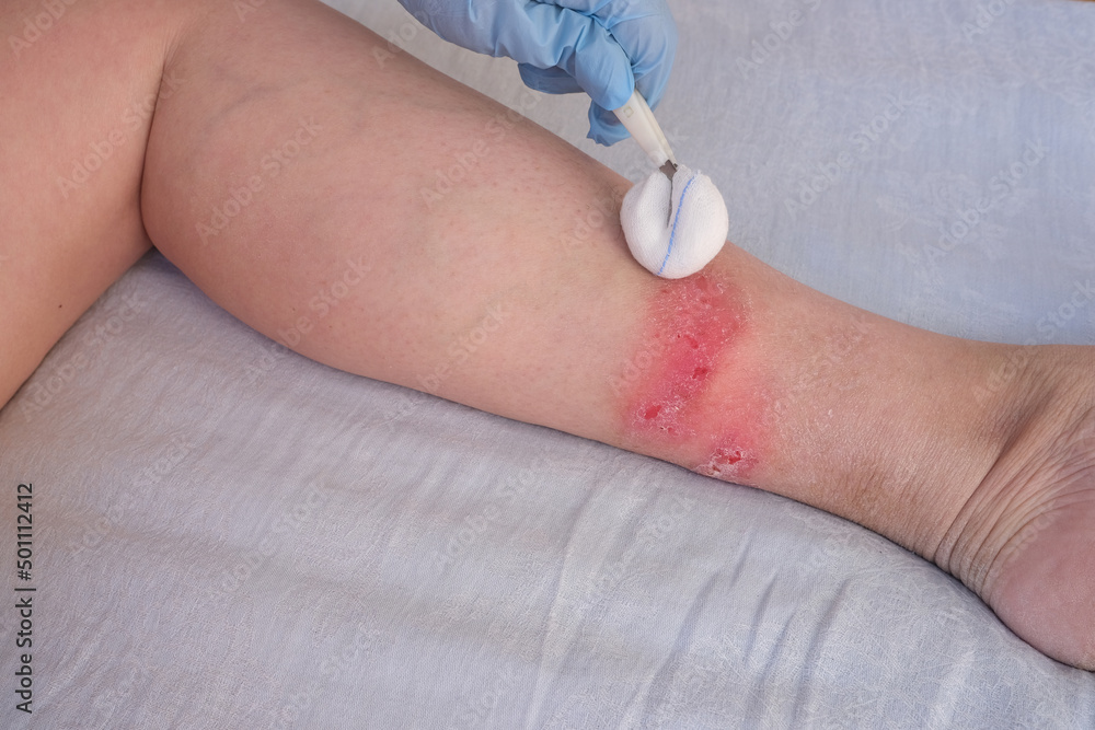 doctor treats large healing wound from on lower leg with scars of adult ...