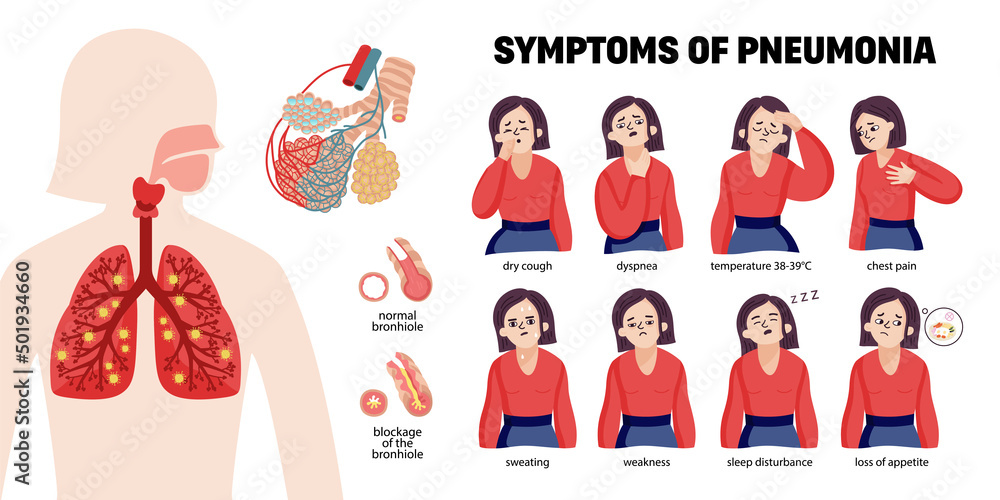 Symptoms Of Pneumonia Infographics Stock Vector | Adobe Stock
