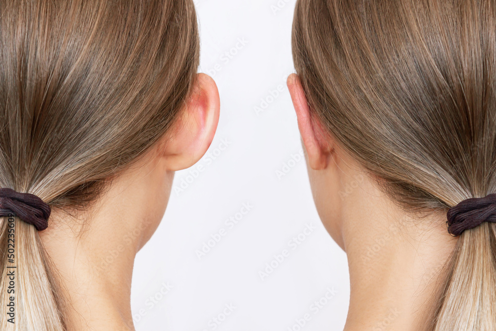 Cropped shot of woman's head with ears before and after otoplasty ...