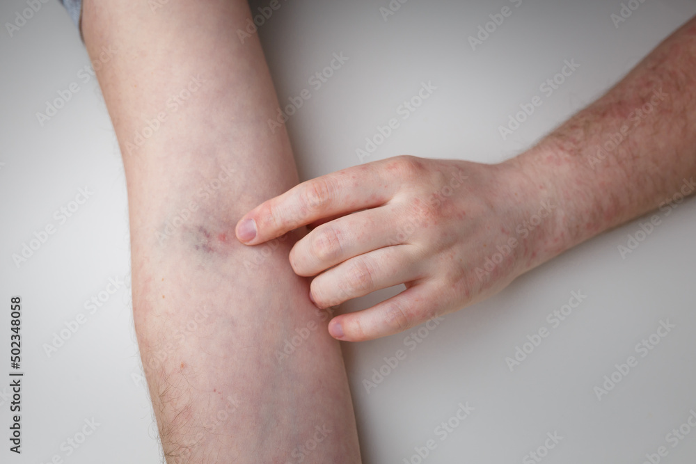 Patient showing syringe injection mark on arm with reddness and blue ...