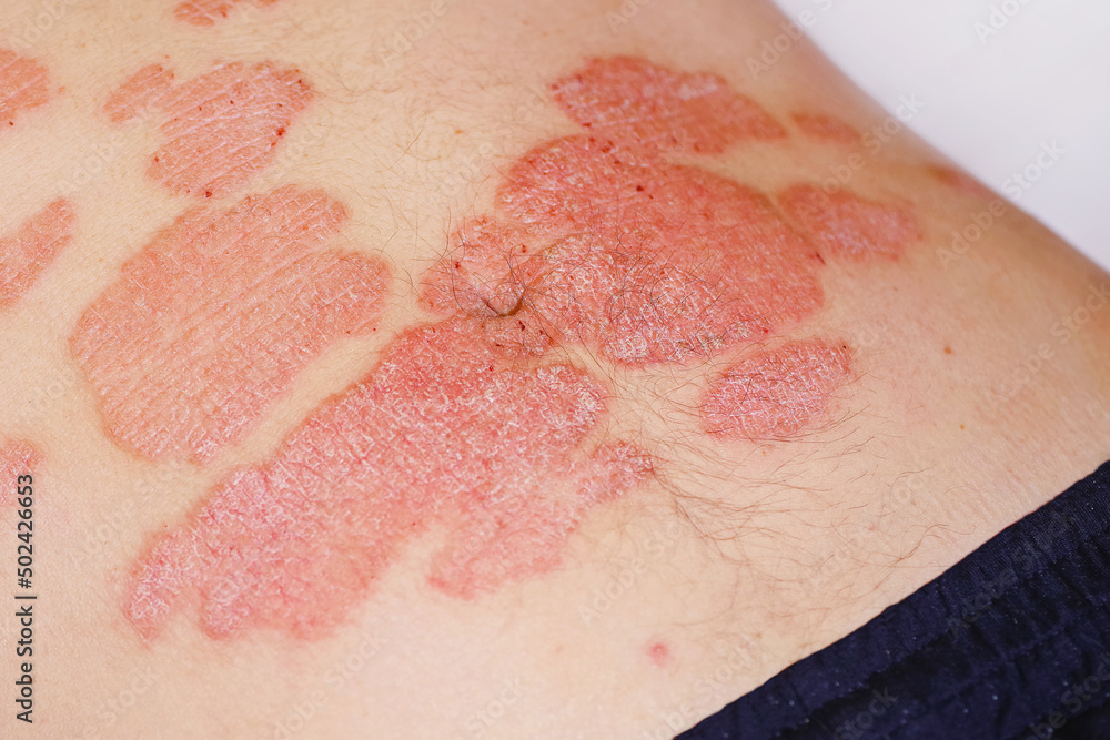 Acute psoriasis on the stomach in a man, severe redness on the skin, an ...