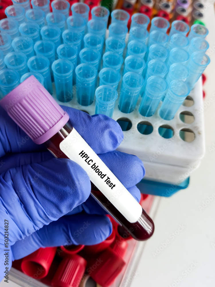 Blood sample for HPLC (High Performance Liquid Chromatography) test to ...