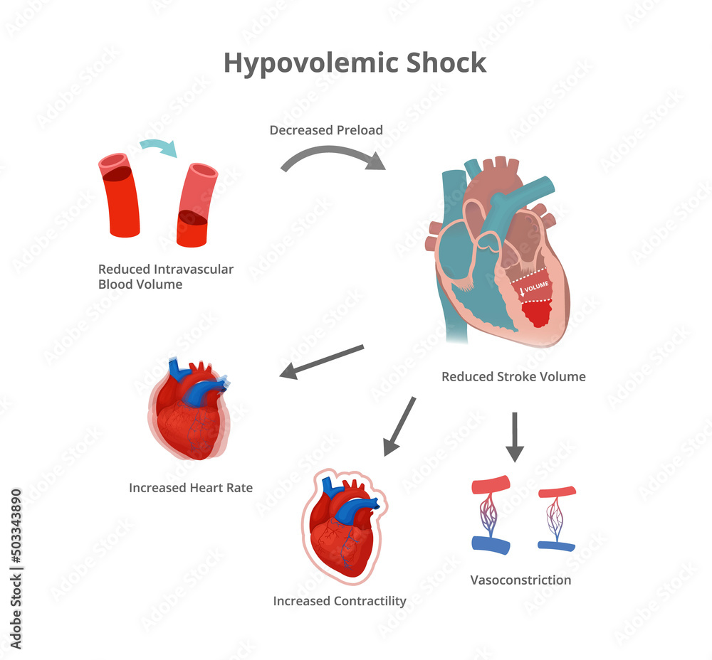 Hypovolemic shock pathology. Compensatory mechanisms of hypovolemic ...