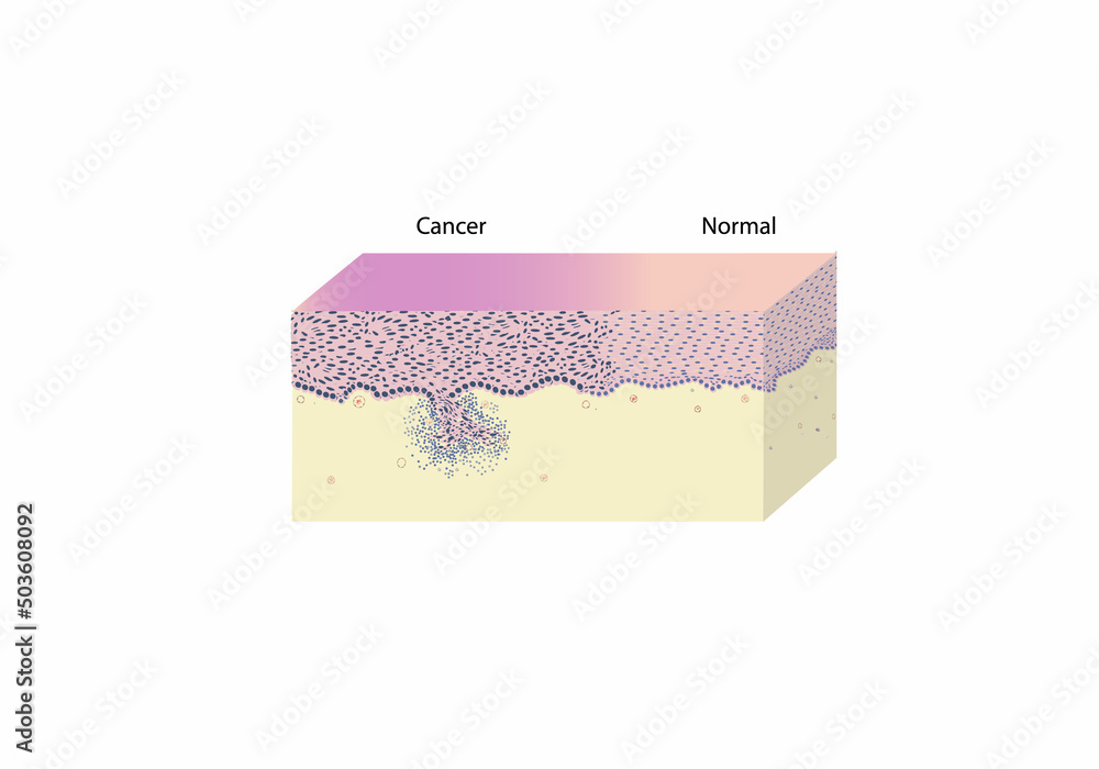 morphology of cervical cancer under a microscope, illustration, vector ...