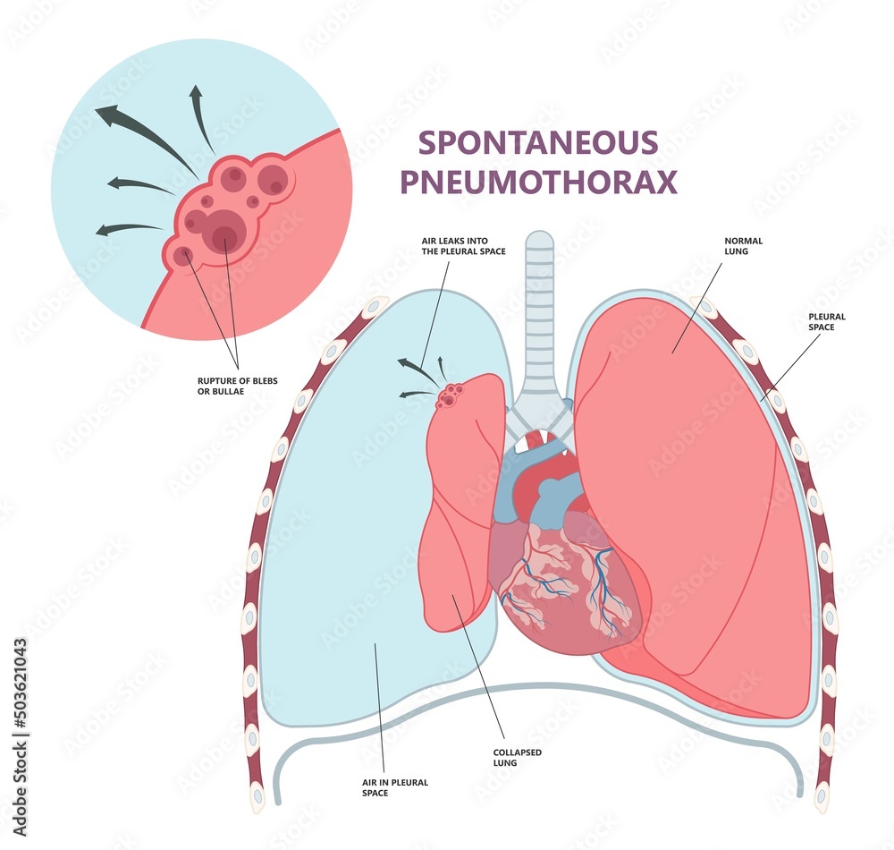 Vector de Stock Lung cancer collapse chest pain drain rib bleb blunt ...