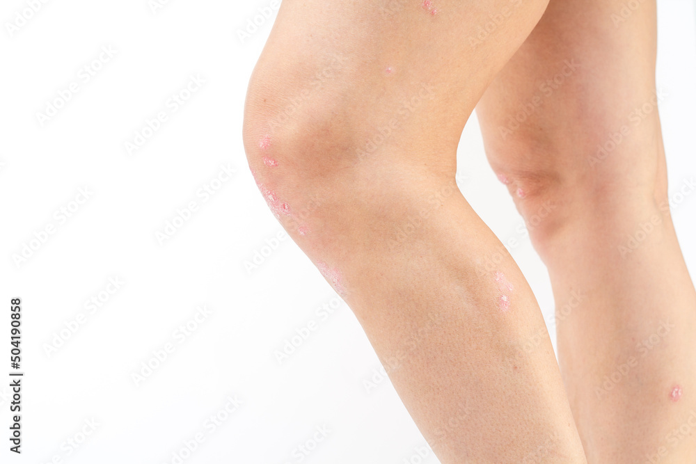 Knee joint effusion.Psoriatic arthritis, meniscus injury.Excess ...