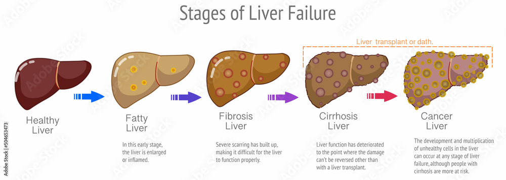 Stock-Vektorgrafik „Stages liver failure, cancer, transplant disease ...