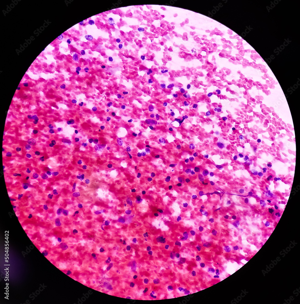 Chronic granulomatous inflammation with tuberculosis, vertebral and ...