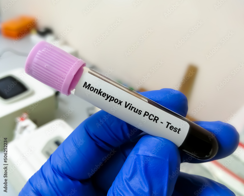 Blood sample for Monkeypox virus PCR test. It is also known as the ...