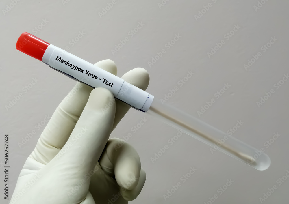 Vesicles fluid sample for Monkeypox virus test. It is also known as the ...