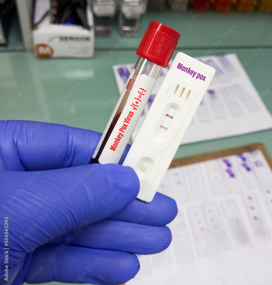 Blood sample tube with rapid test kit for Monkeypox virus test. It is a ...