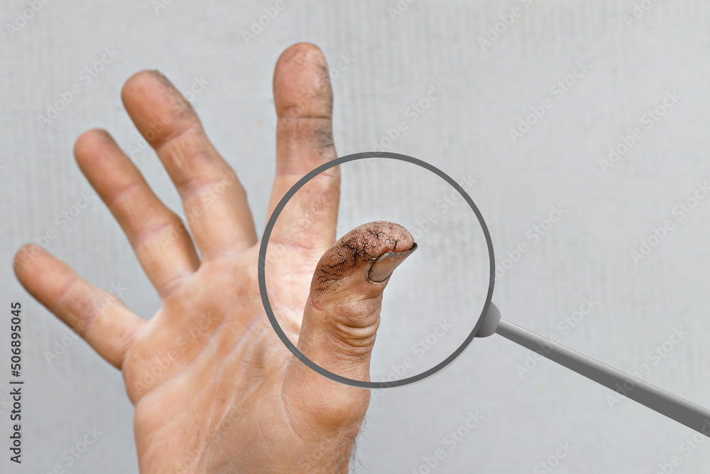 dry skin of the hand and fingers of a man with cracks and vitamin ...