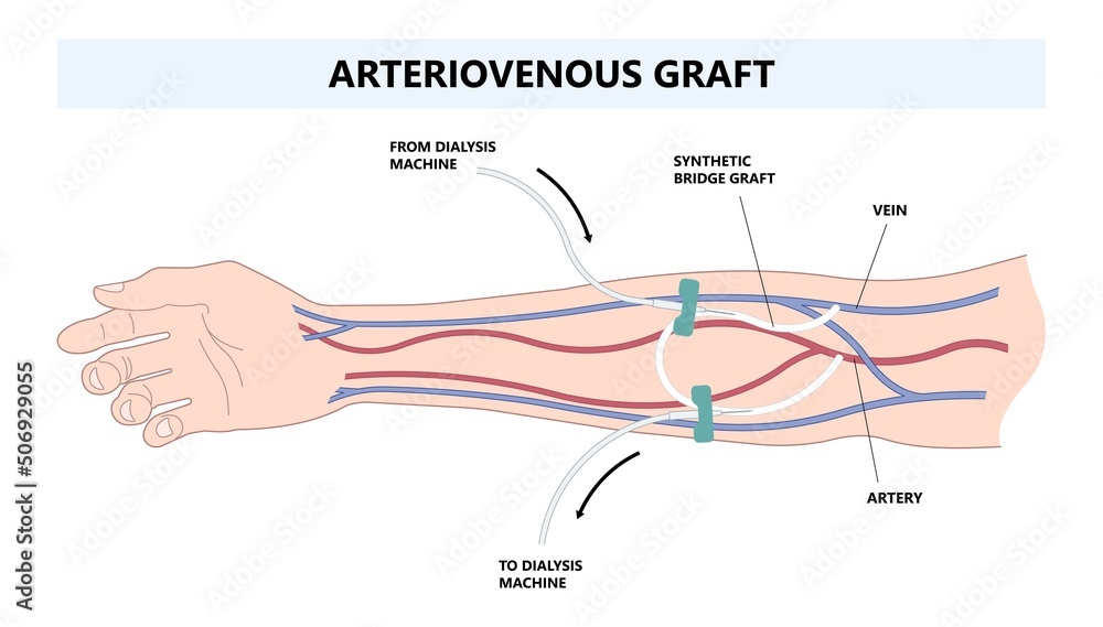 Vascular access for kidney graft shunt lumen with PICC line tube chest ...