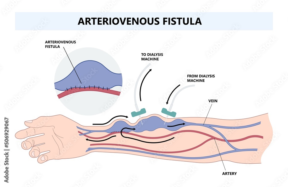 Vascular access for kidney graft shunt lumen with PICC line tube chest ...