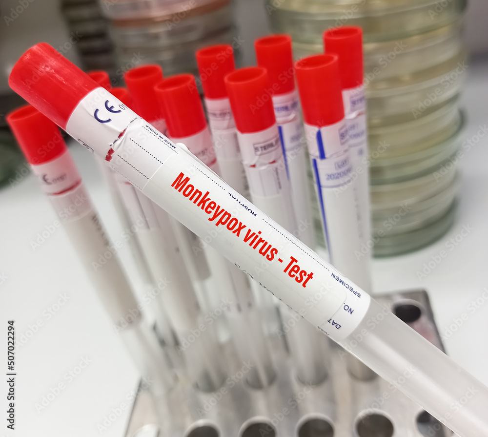 Vesicles fluid sample for Monkeypox virus test. a double-stranded DNA ...