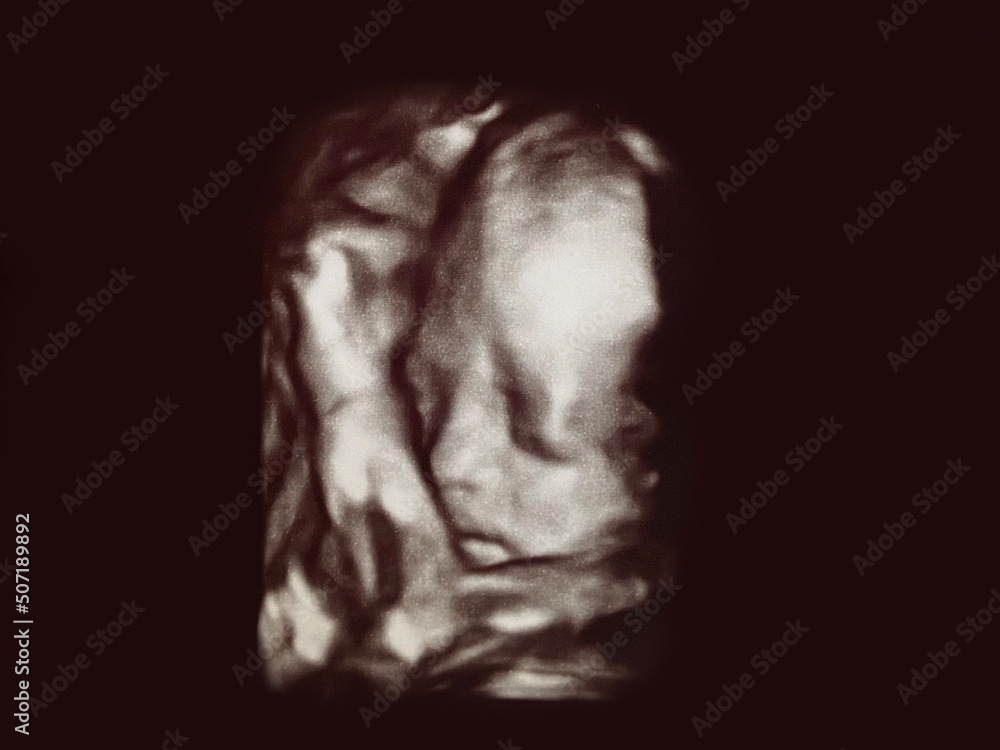fetal baby ultrasound picture Stock Photo | Adobe Stock