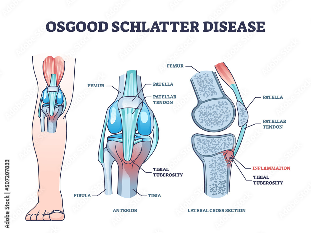 Vector de Stock Osgood schlatter disease condition with leg and knee ...