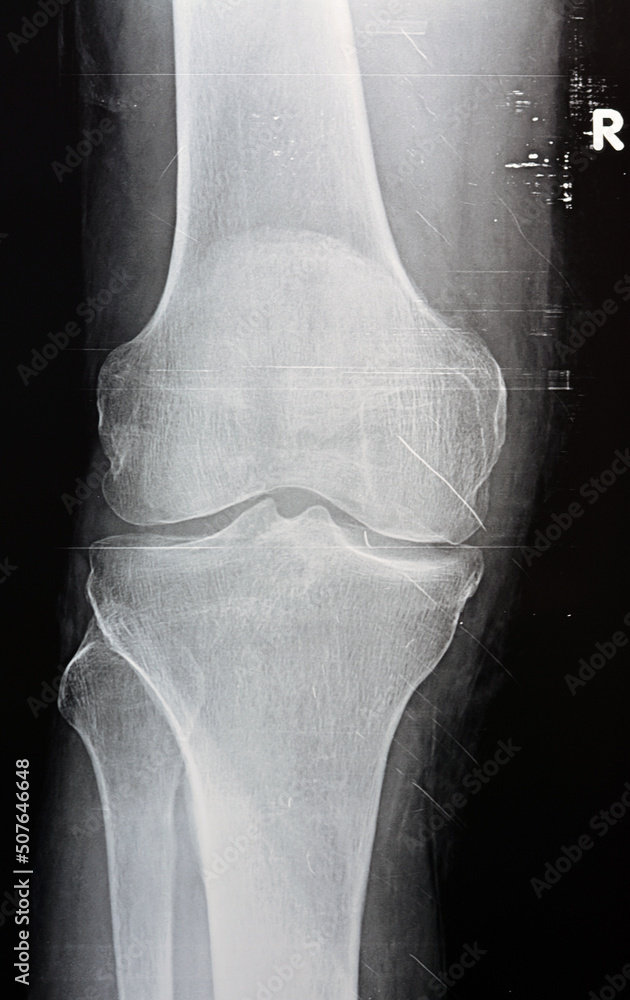 Plain X ray of the right knee shows apparent joint osteoarthritis ...