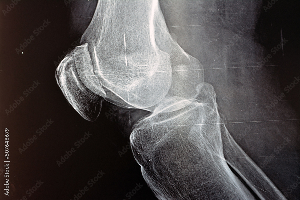 Plain X ray of the right knee shows apparent joint osteoarthritis ...
