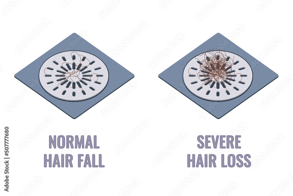 Hair clumps stuck in the shower drain grids. Normal hair fall versus ...