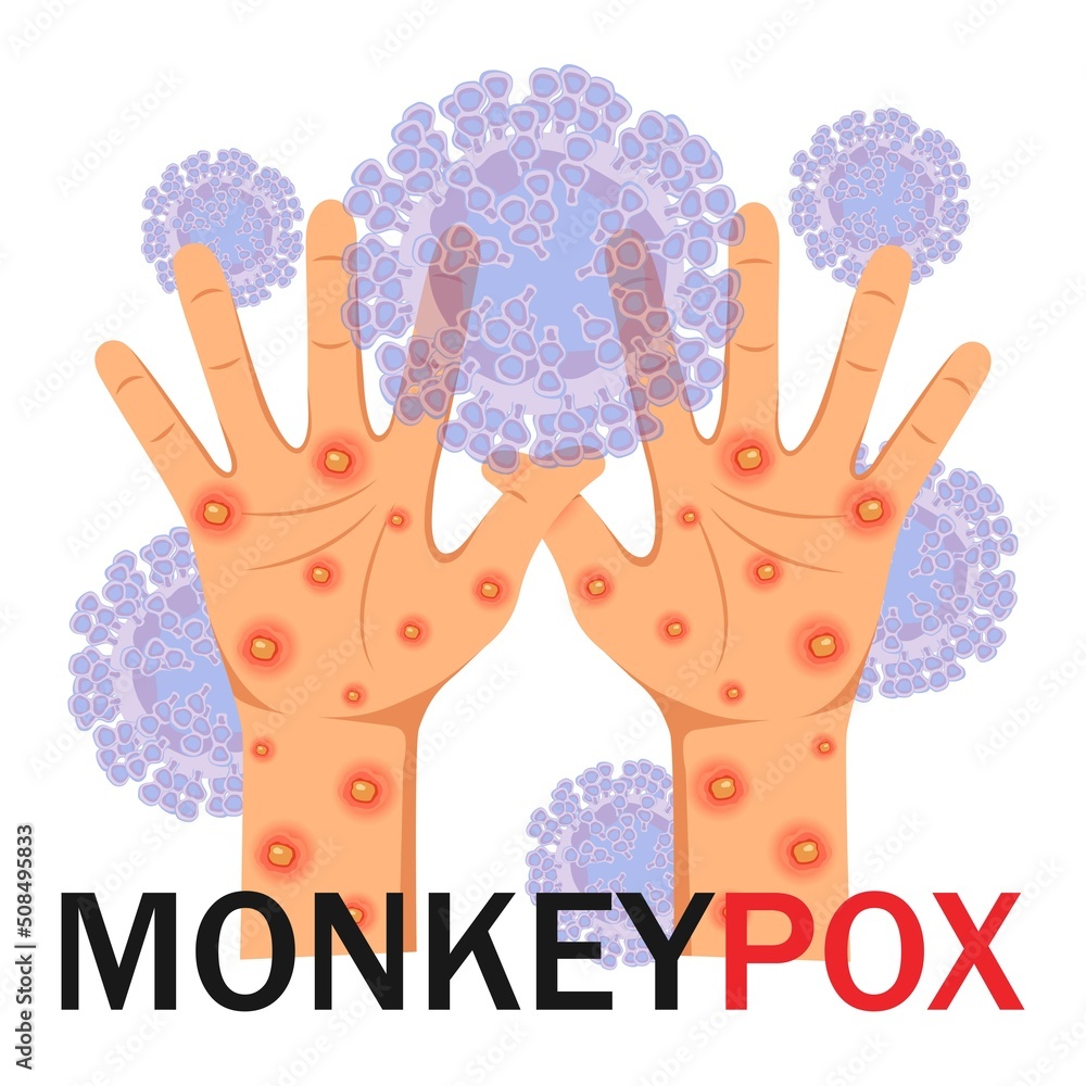 Monkeypox virus. Human hands with a rash on a microbiological ...