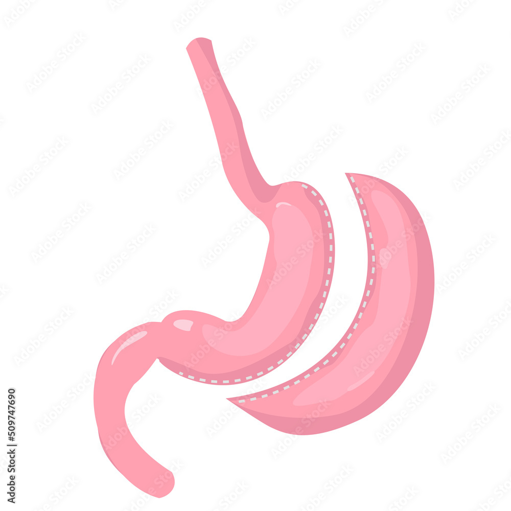 Gastric sleeve stomach. Methods of bariatric surgery. Human anatomy ...